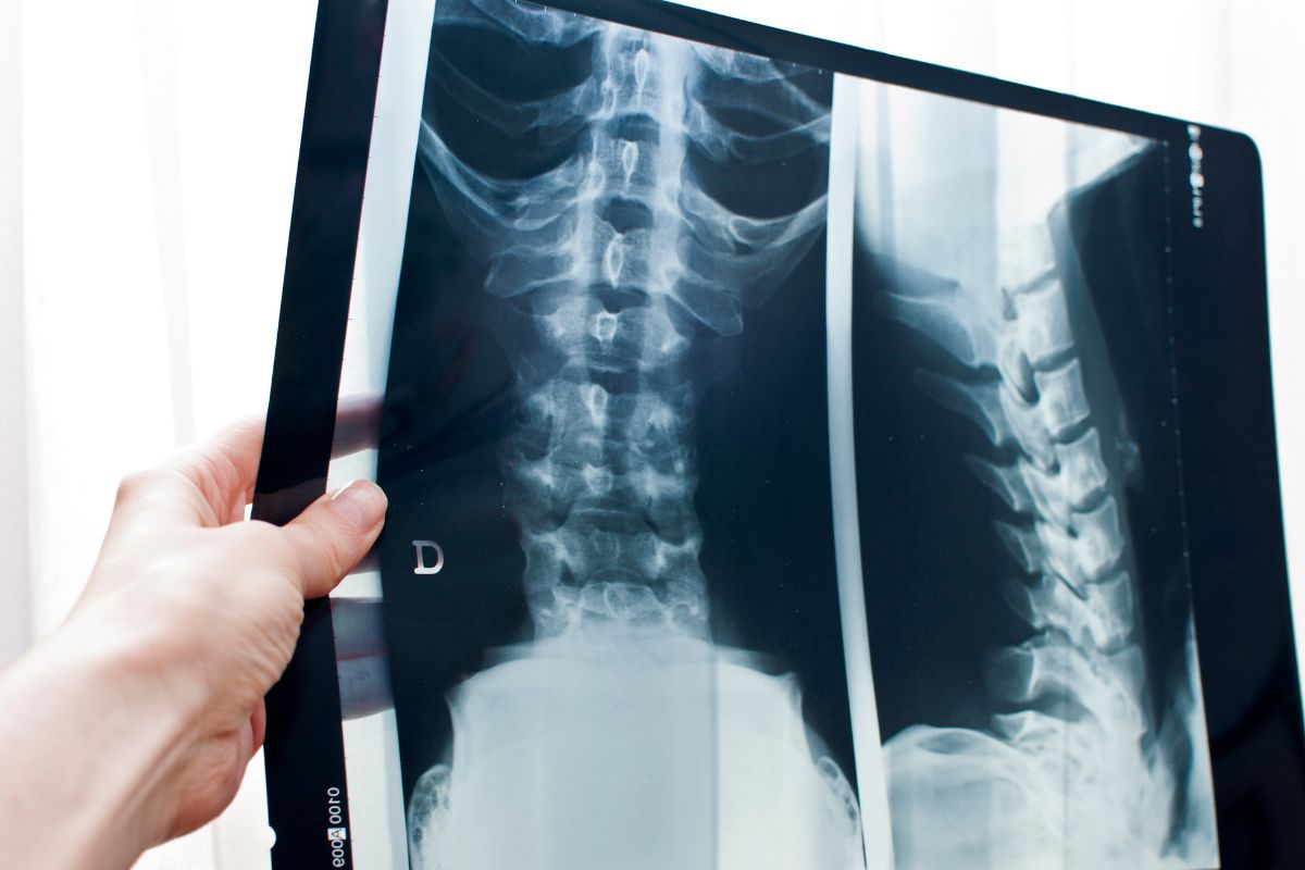 Radiografia alla schiena, quali patologia aiuta a diagnosticare. - CMR ... Radiografia alla schiena, quali patologia aiuta a diagnosticare. - CMR ...